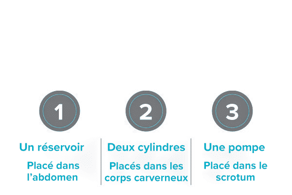 Comment l’implant pénien gonflable fonctionne-t-il ? | Erection et ...